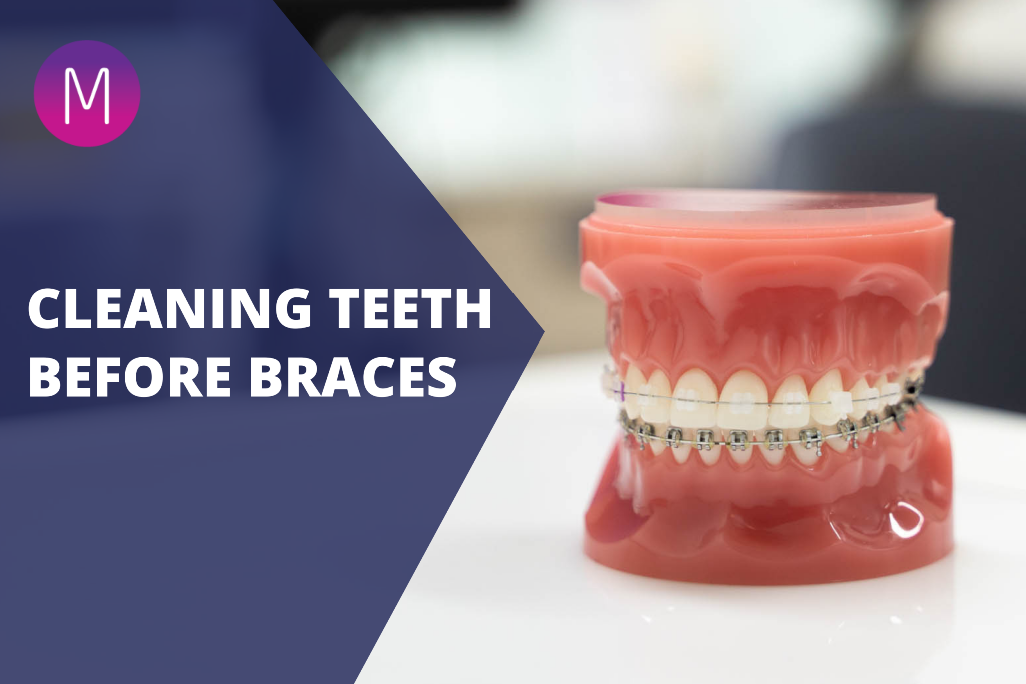 Should You Clean Your Teeth Before Getting Braces?