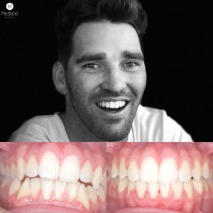 Invisalign Gold Coast | Orthodontic Treatments| Medland Orthodontics