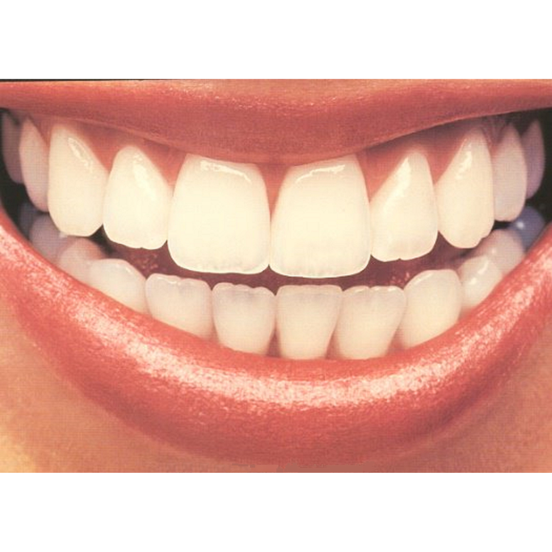 Invisalign Refinements - Why It's needed? - Medland Orthodontics